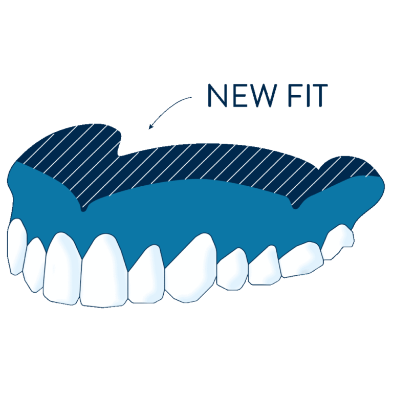 Partial Dentures for Front Teeth | The Denture Studio